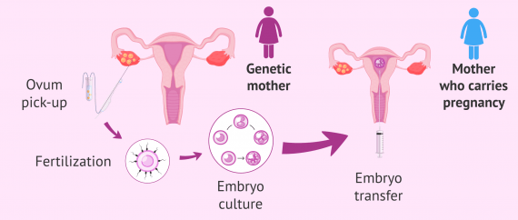 Having a child with donor sperm through reciprocal IVF