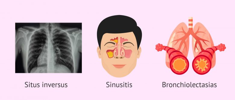 Kartagener Syndrome: Definition, Causes and Symptoms