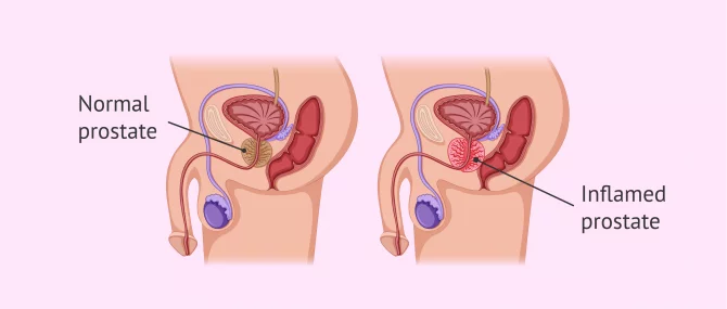 Common Causes Of Prostate Infection