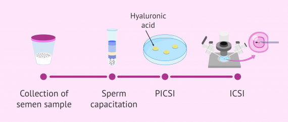 What Is PICSI or Physiological ICSI in IVF?