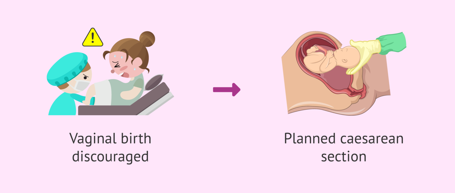 Planned cesarean section, when is it indicated, and what are the risks?