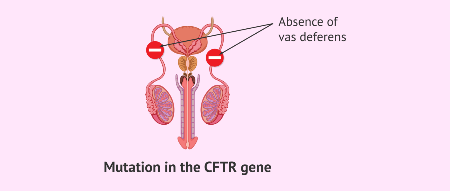 Absence of vas deferens due to cystic fibrosis