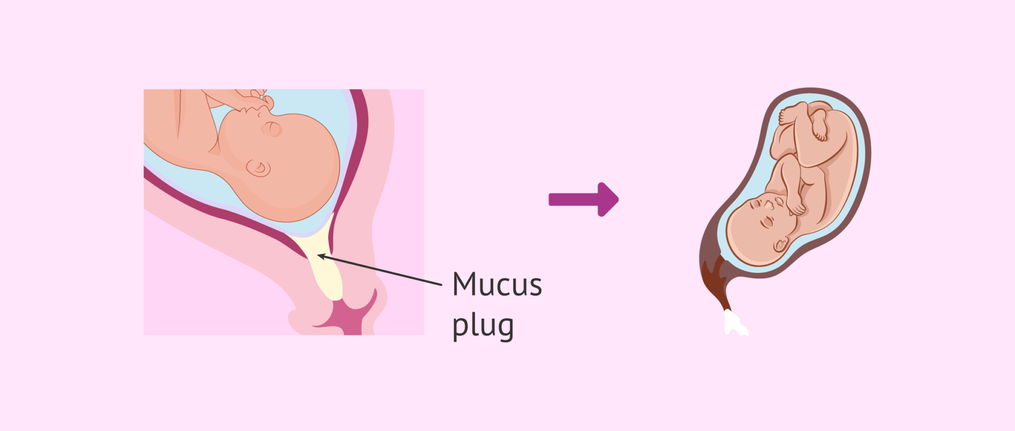 Mucus plug discharge