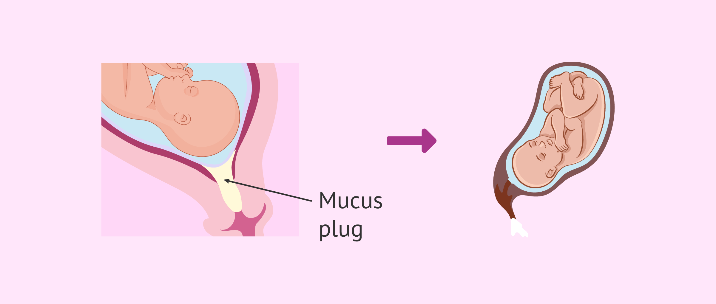 Mucus plug discharge
