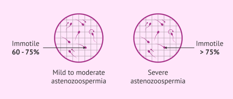 What is asthenozoospermia? - definition, causes and treatment