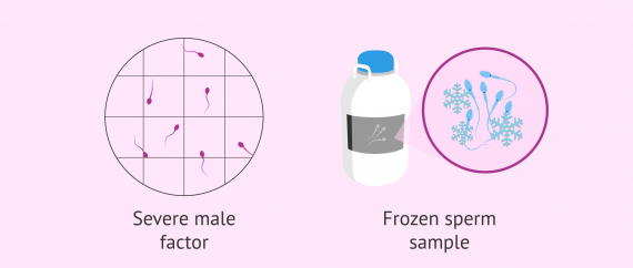 Fertile Chip in IVF: How does It Work and When Is it Indicated?