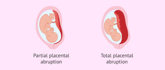 Total and partial placental abruption