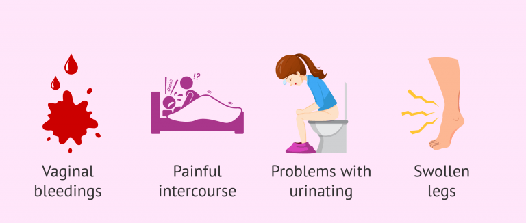 Clinical manifestations of cervical cancer