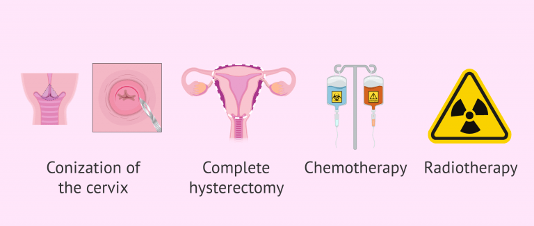 Cervical Cancer: Symptoms, Diagnosis, Treatment & Prevention