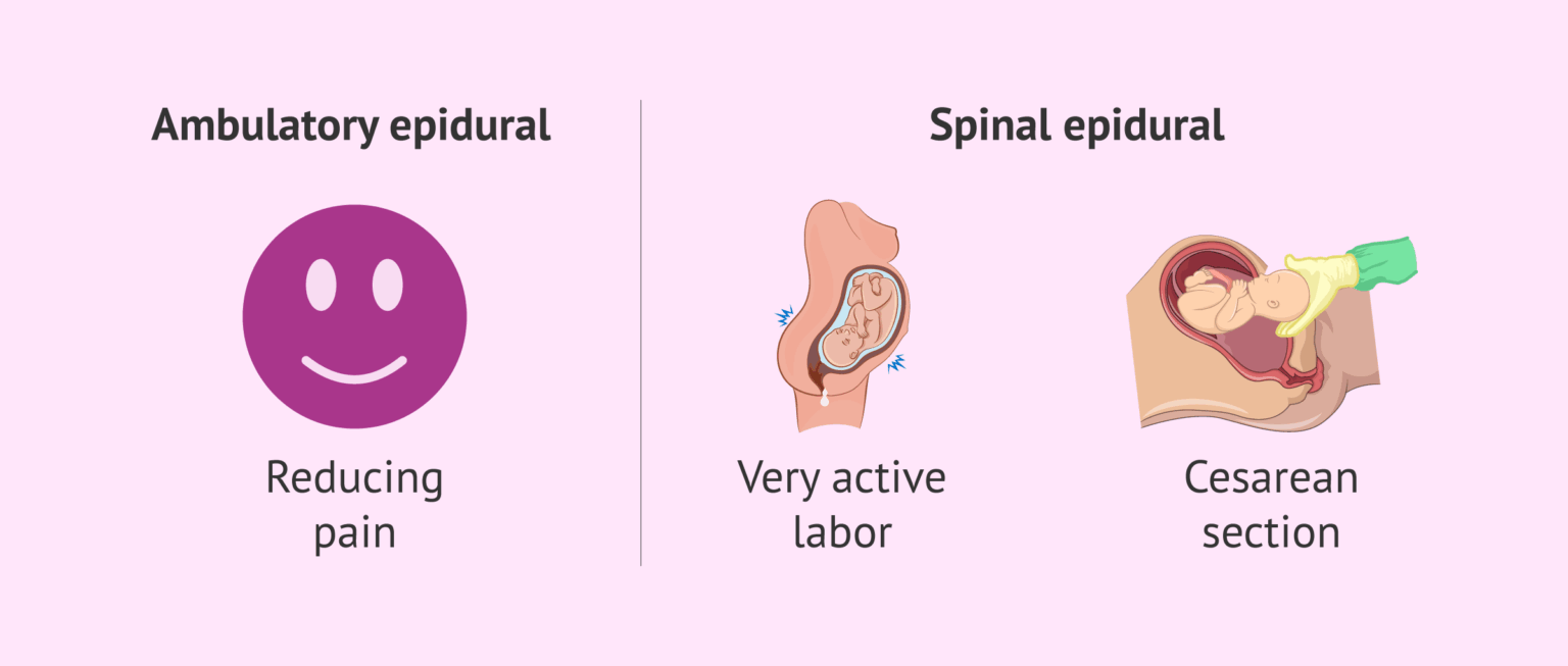 Epidural Anesthesia During Labor: Benefits & Side Effects