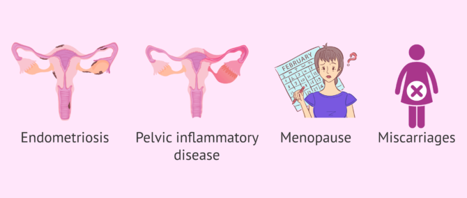 Retroverted Uterus Meaning Retroverted uterus what it means in ...