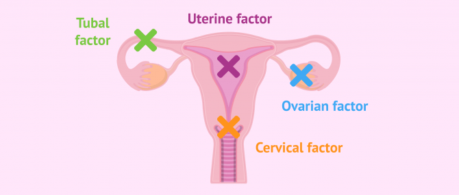 What s the Difference between Infertility Sterility Subfertility