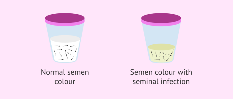 Normal and altered semen color