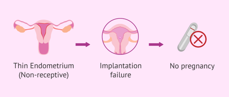 What is endometrial scratching - Indications and procedure