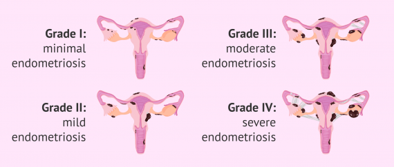 What are the degrees of endometriosis?