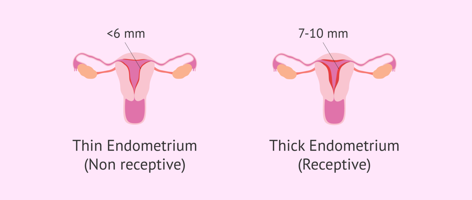 A thin endometrium and a receptive endometrium.