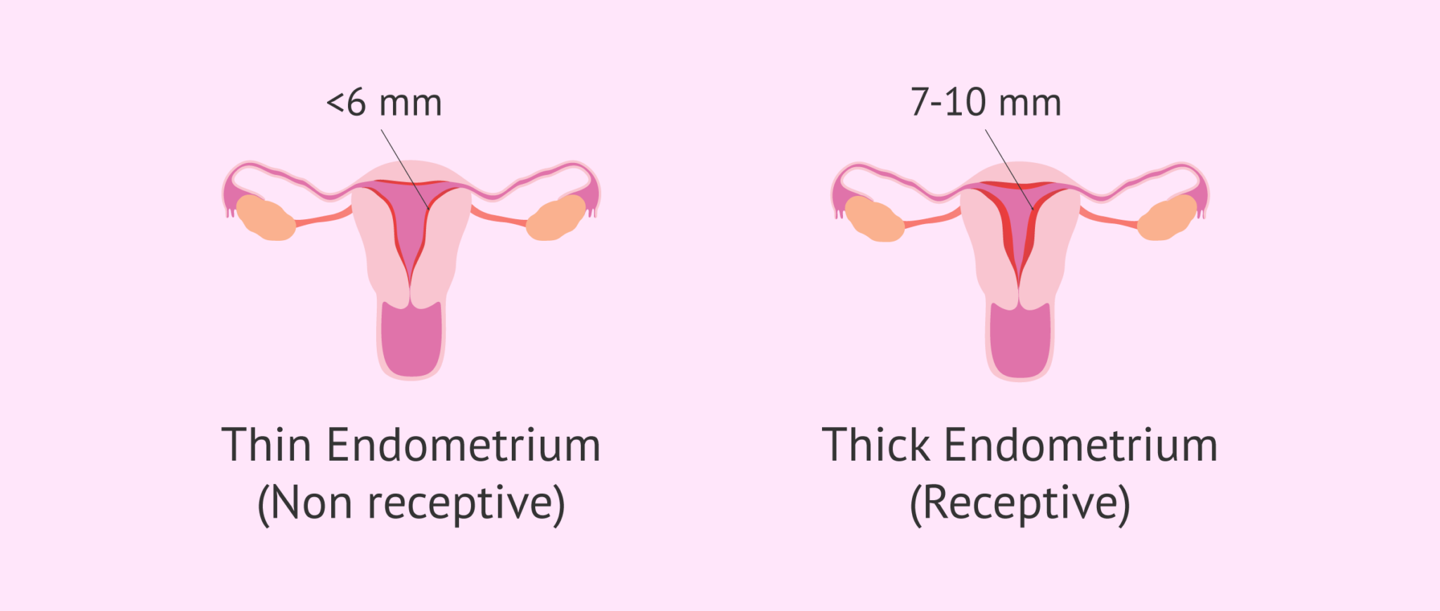 A thin endometrium and a receptive endometrium.