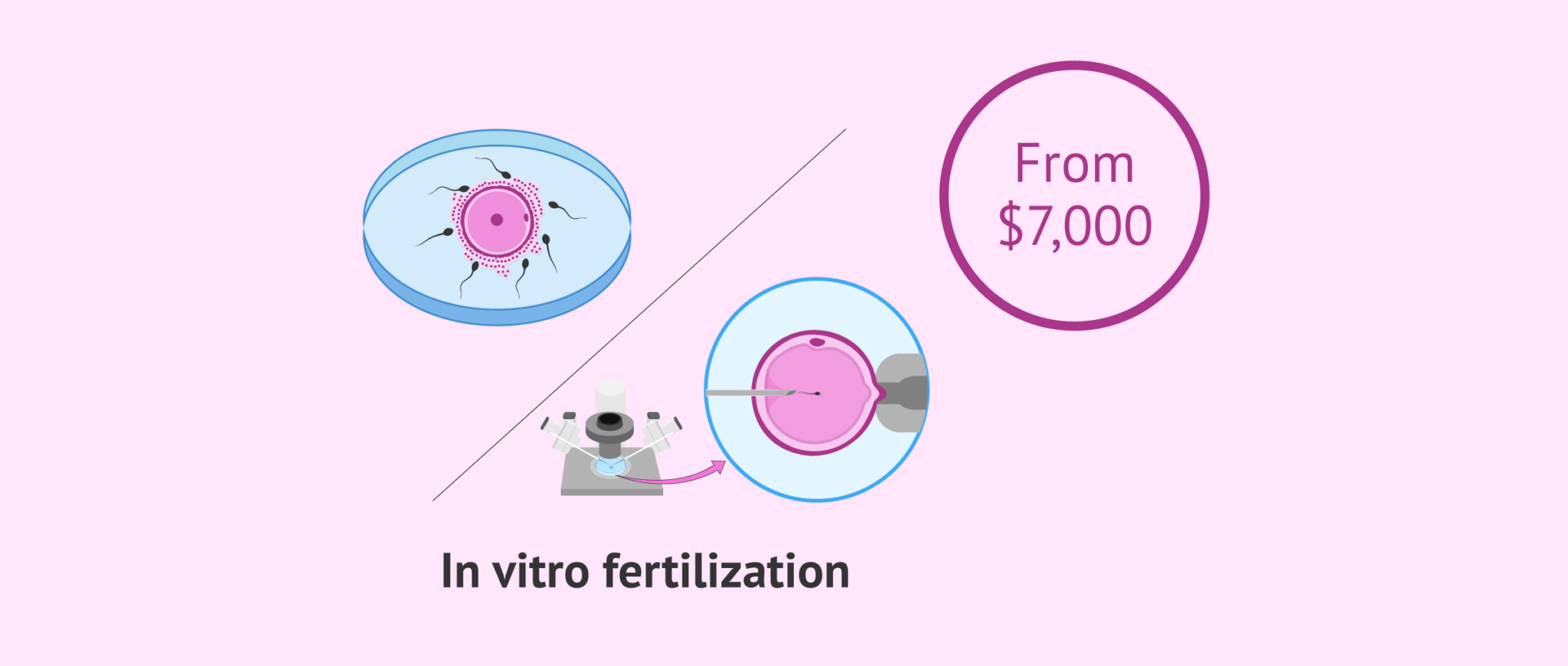 In vitro fertilization (IVF) - What is it and how much does it cost?