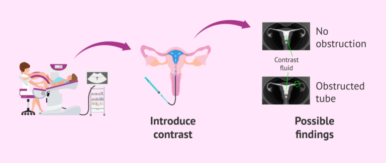 Types of hysterosalpingography: advantages, risks, and limitations