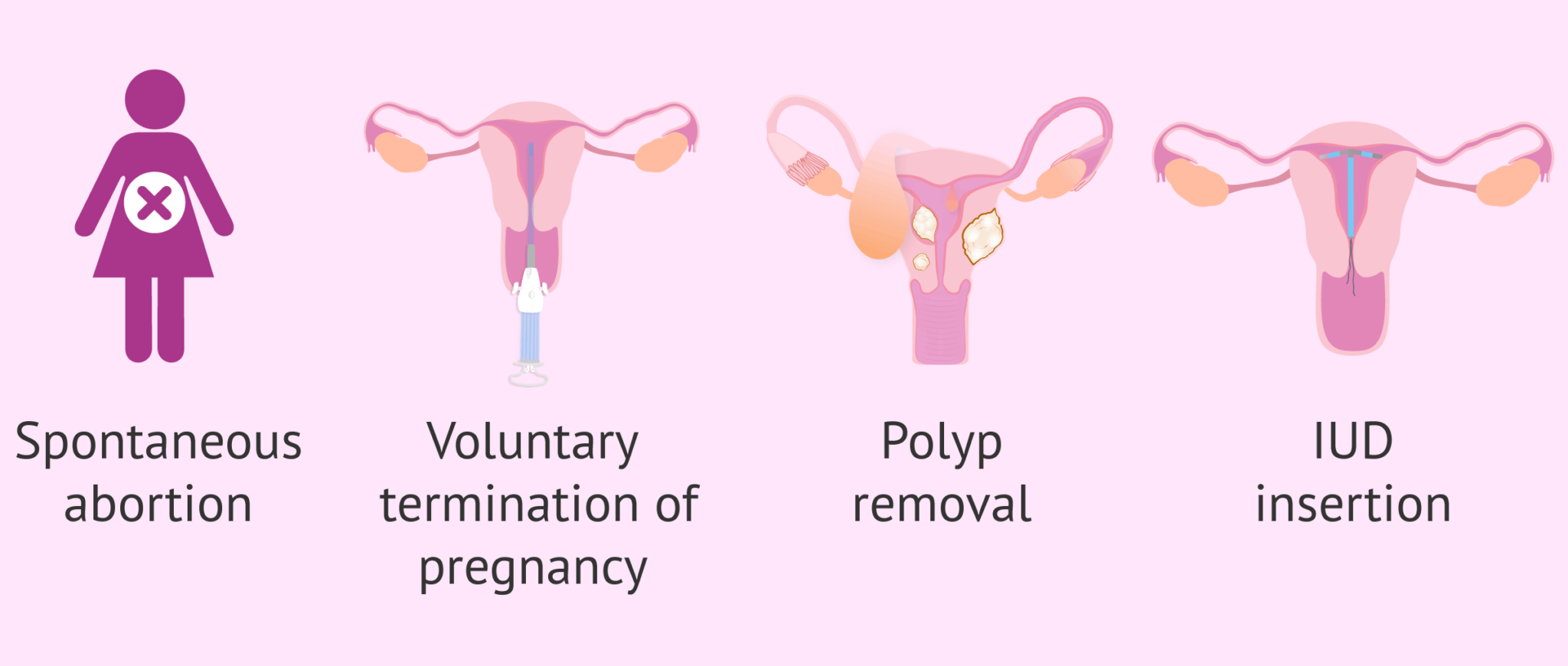 Uterine curettage - procedure, recovery and complications