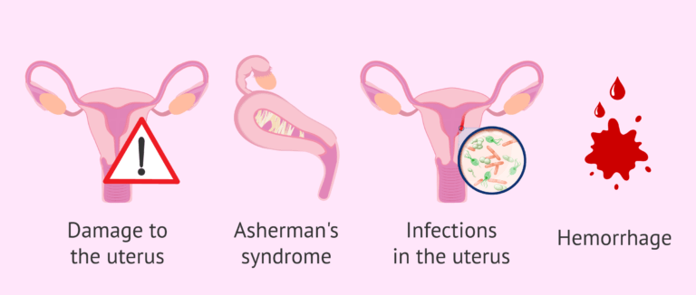 Uterine curettage - procedure, recovery and complications