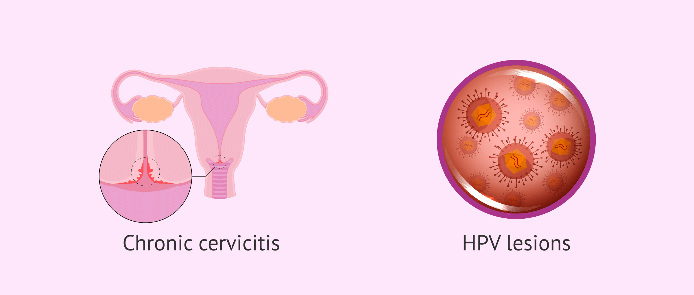 Indications For Cauterization Of The Uterine Cervix Indications For Cauterization Of The Uterine Cervix