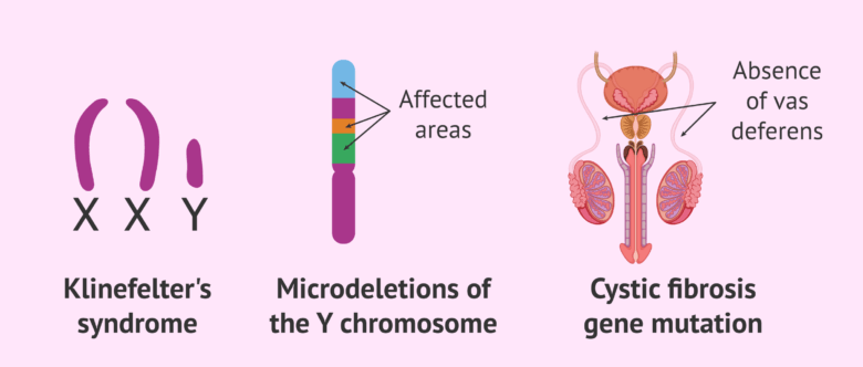 Genetic infertility: causes, diagnosis and treatment