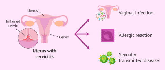 Possible causes of cervicitis