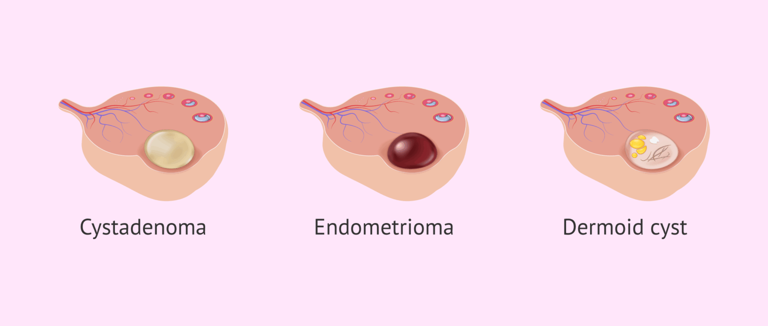 What are the types of non-functional ovarian cysts?