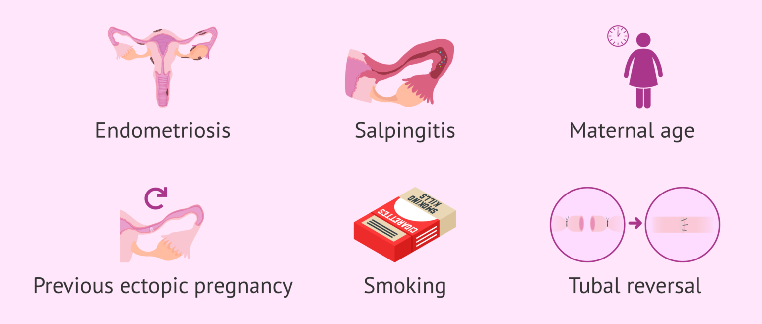 What Is Ectopic Pregnancy Types Symptoms And Diagnosis