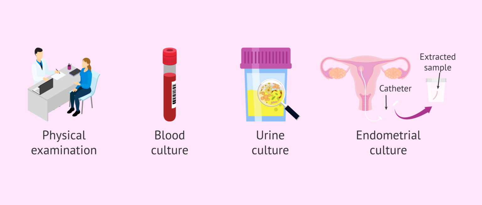 What is puerperal fever? - Symptoms, causes and treatment