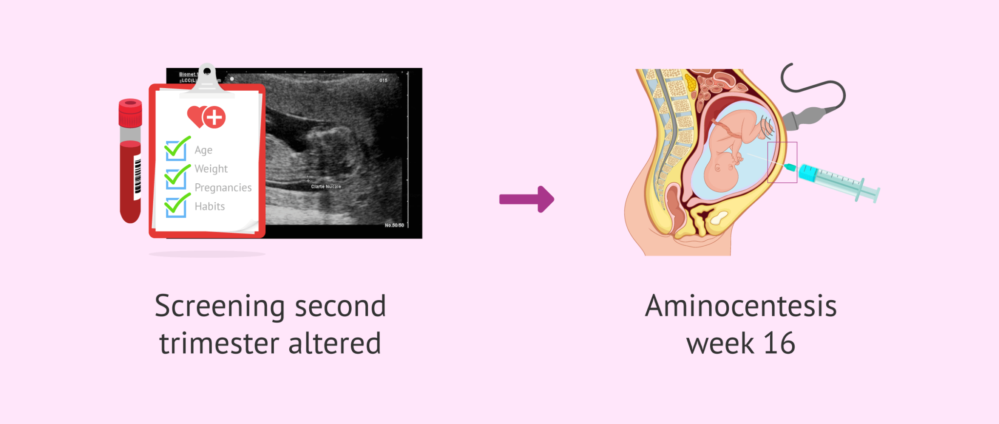 Complement second trimester screening with amniocentesis