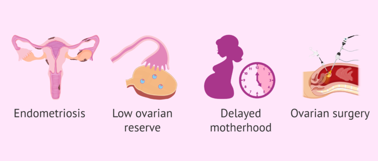 What is fertility preservation? - cryopreservation of eggs and sperm