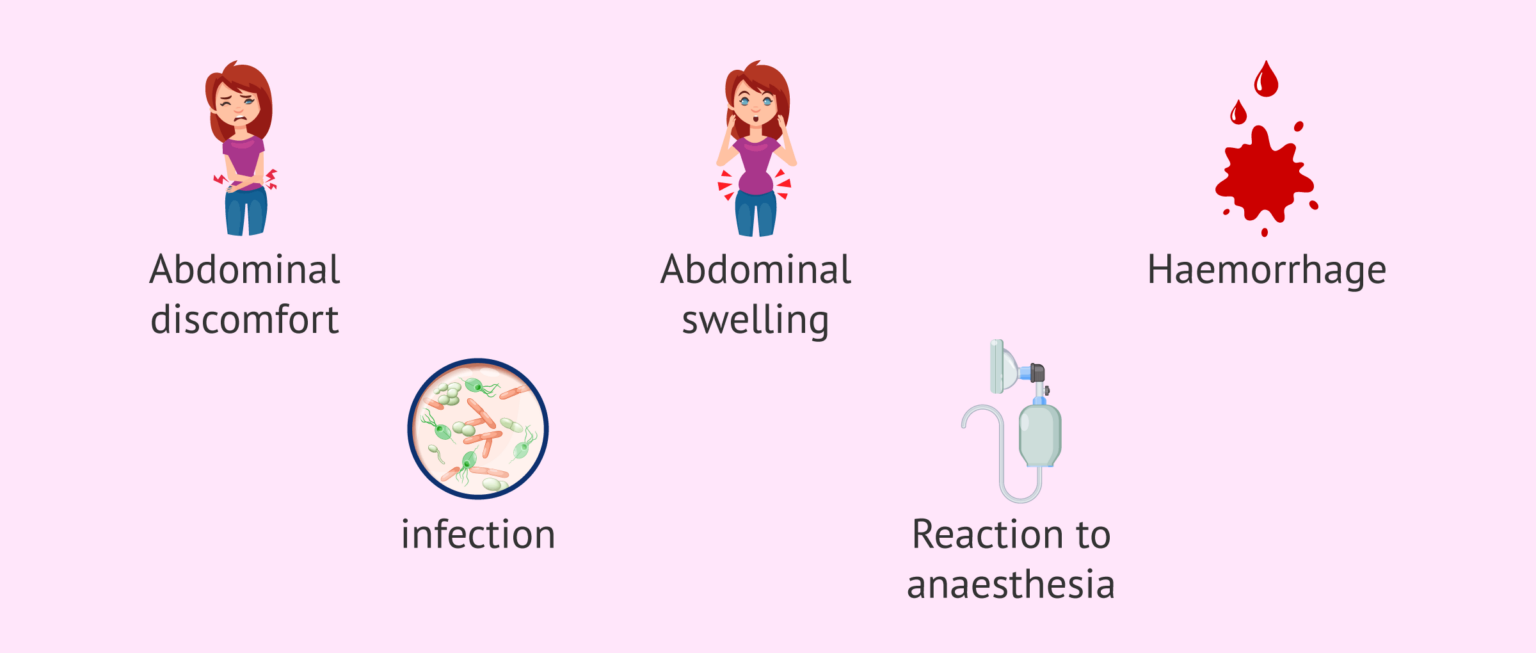 Salpingectomy: how and why are the Fallopian tubes extracted?