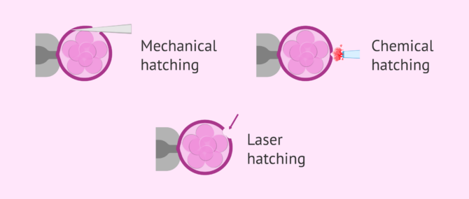 Assisted hatching before embryo transfer