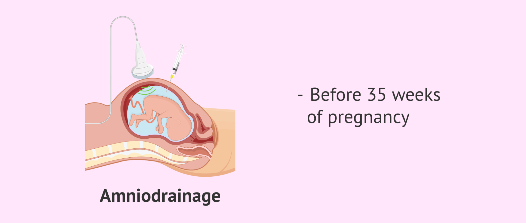 What is amniodrainage?