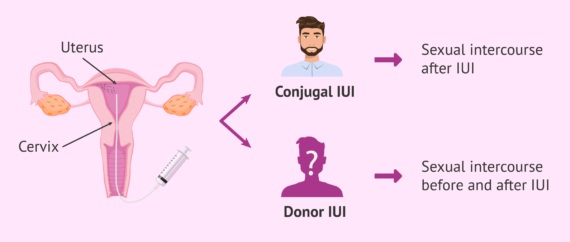 Is sexual intercourse possible after AI?